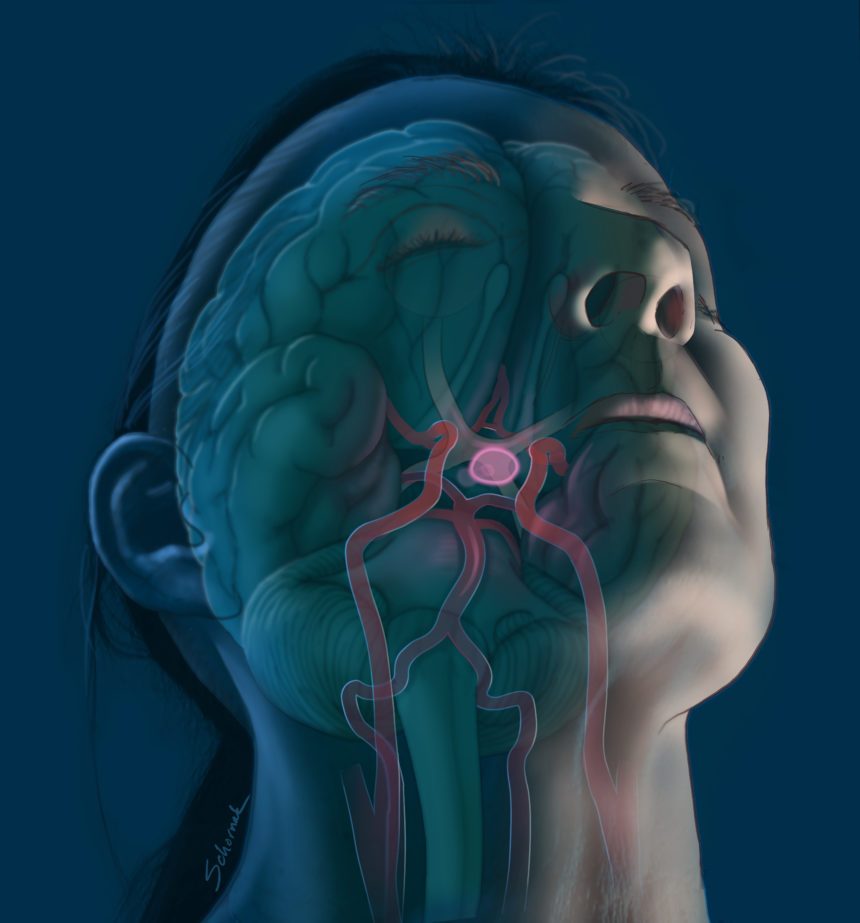 After Years of Mysterious Symptoms, a Life-Changing Diagnosis | UNC ...